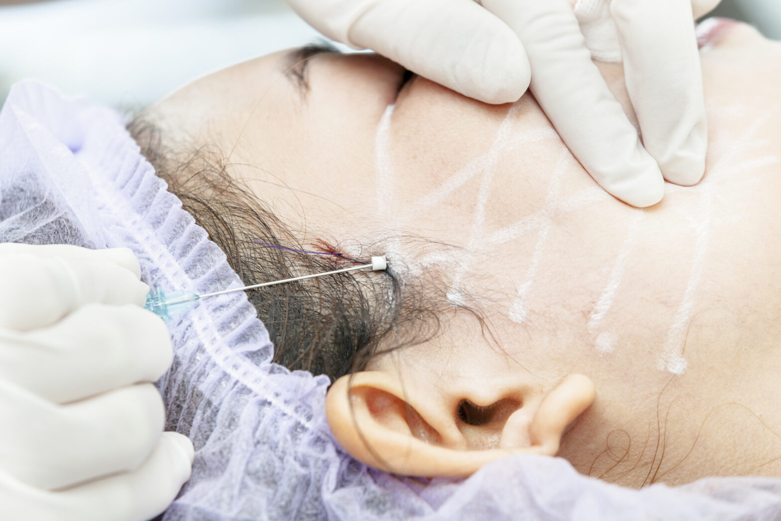 How to Sleep Better After PDO Threads Lift | Elements Dental Spa ...