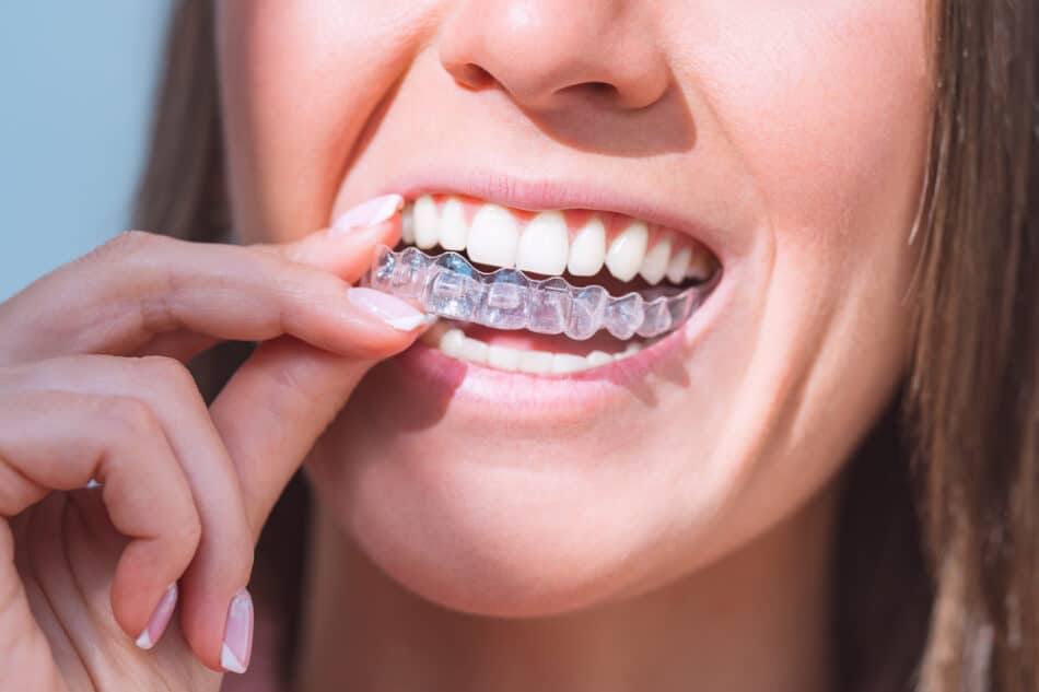 When Do Teeth Start Moving With Invisalign | Elements Dental Spa ...
